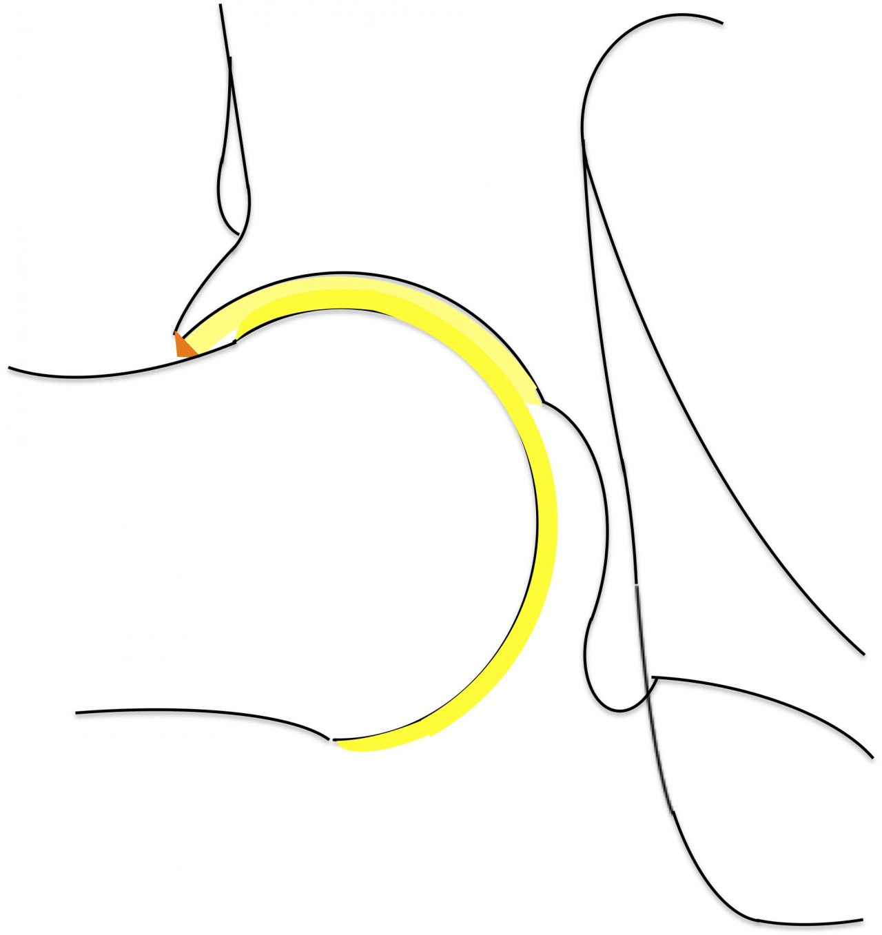 Hip Arthroscopy - The London Hip Practice